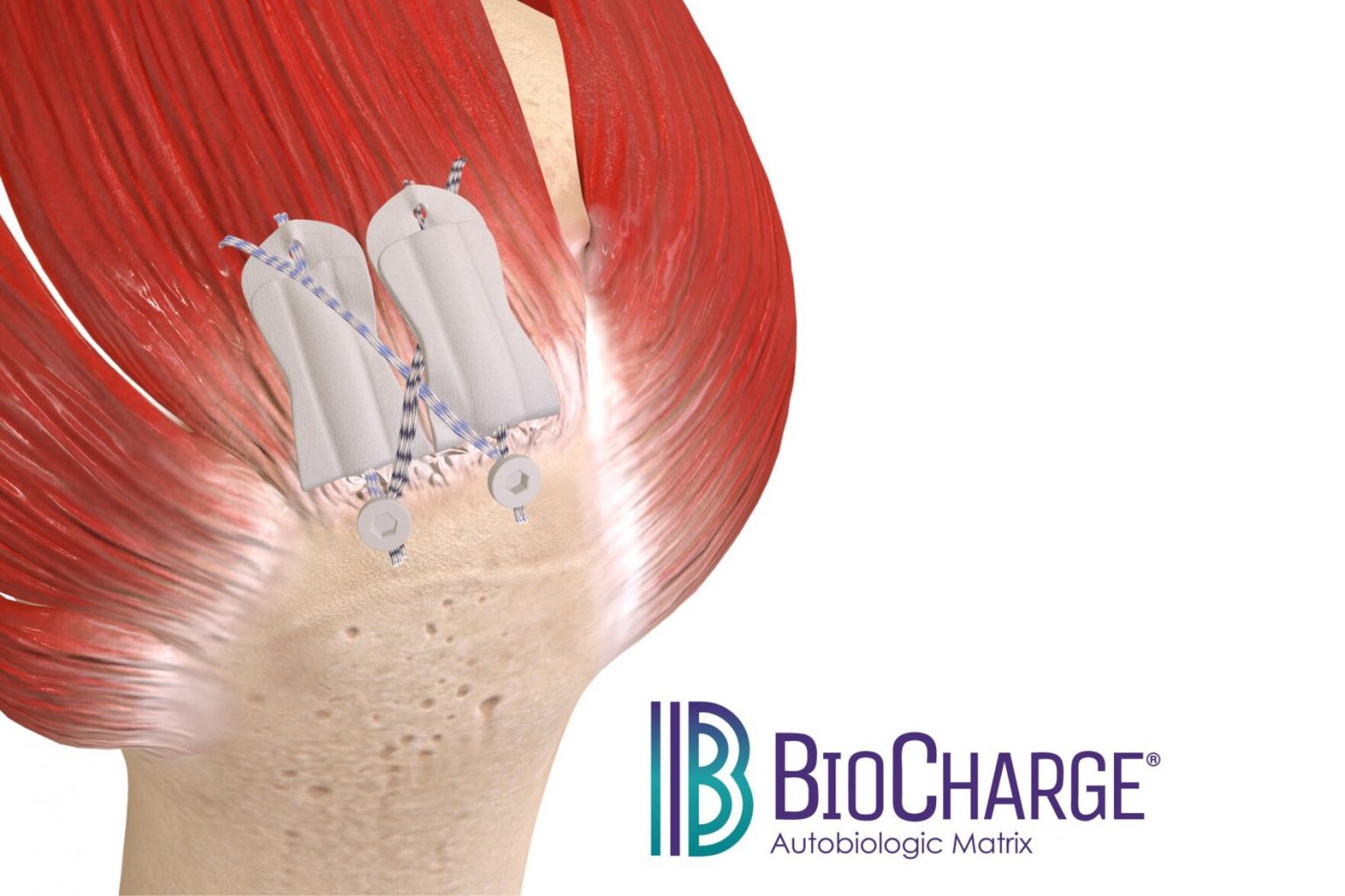 Atreon Orthopedics Announces FDA 510(k) Clearance and Full Market ...